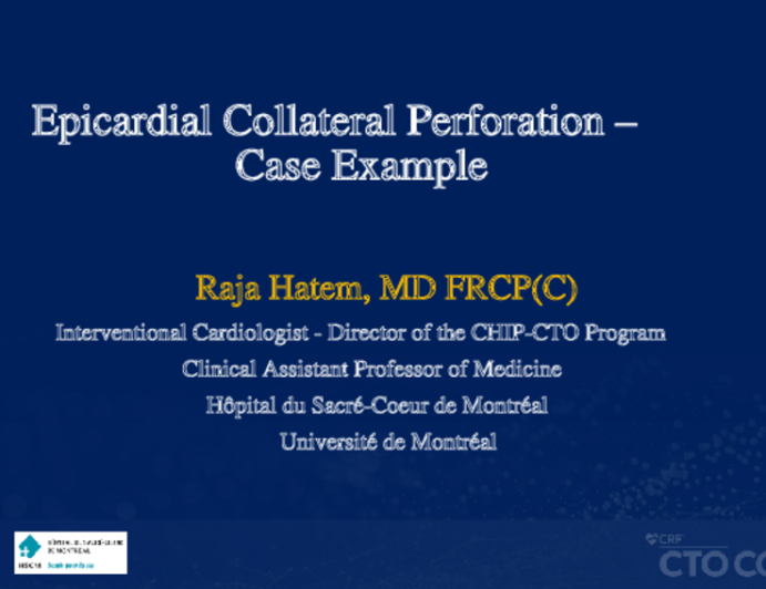 Epicardial Collateral Perforation – Case Example | tctmd.com